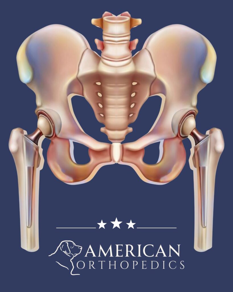 Anterior Total Hip Arthroplasty - American Orthopedics